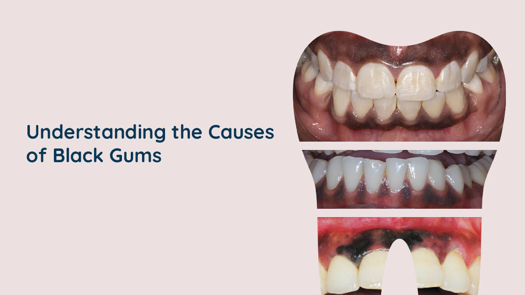 Understanding the Causes of Black Gums