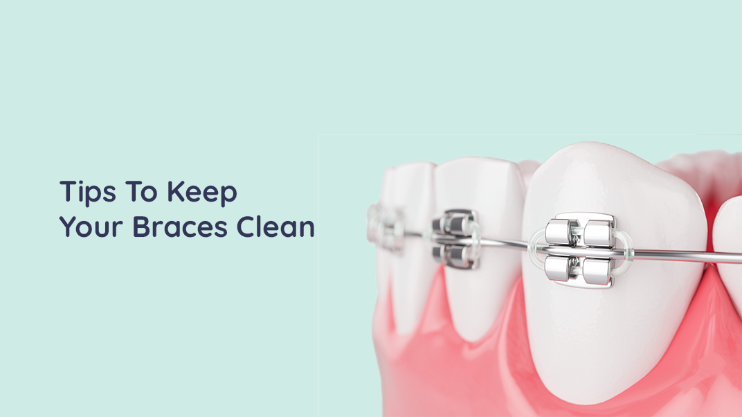 Tips To Keep Your Braces Clean – ORACURA